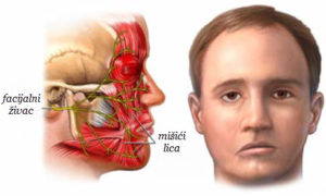 Pareza facijalis simptomi upale živca na licu - Dijeta Mesečeve Mene
