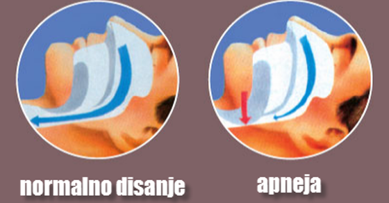 Apneja u snu simptomi i prirodno lečenje | Dijeta Mesečeve Mene