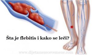 Upala vena na nogama i rukama | simptomi | prirodno lečenje