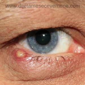 Čmičak na oku kako se leči i koliko traje | prirodni lek | operacija